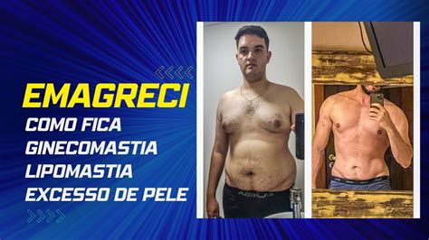 Emagreci 40 Kg O Que Fazer Excesso De Pele Ginecomastia E