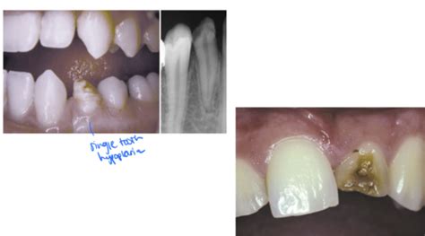 Abnormalities Of Teeth Flashcards Quizlet