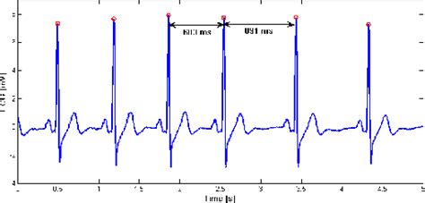 figure 1 from accurate r peak detection and advanced preprocessing of normal ecg for heart rate