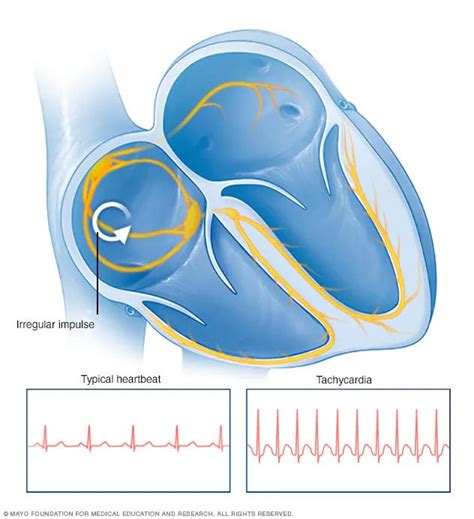 Tachycardia Symptoms And Causes Mayo Clinic