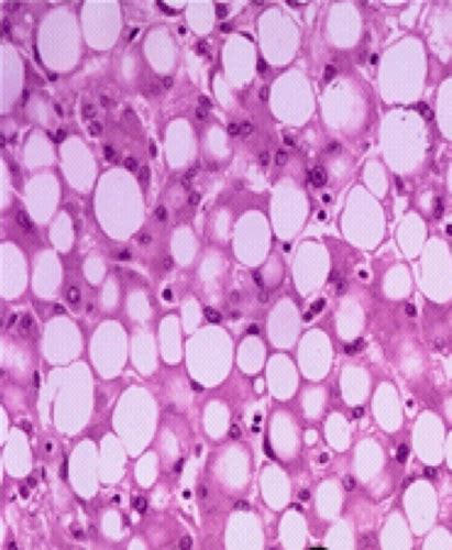 Liver Pathology Flashcards Quizlet