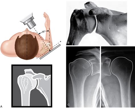Scapula X Ray Positioning