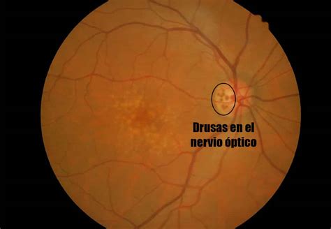 Qué son las Drusas del Nervio Óptico Área Oftalmológica Avanzada