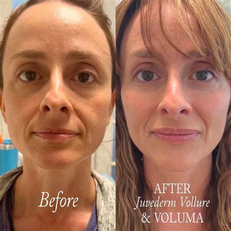 Experience Prolonged Beauty with Juvéderm Vollure XC