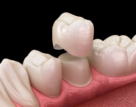 Prótesis dentales fijas sobre dientes
