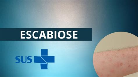 Escabiose Sarna tudo o que você precisa saber YouTube
