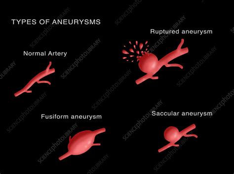 Types Of Aneurysms Stock Image C030 6090 Science Photo Library