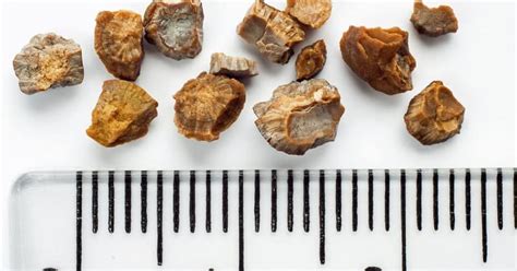 Pietre La Rinichi Calculi Renali Cauze Simptome Si Tratament