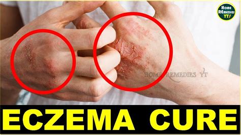 How To Get Rid Of Eczema Permanently Natural Eczema Treatment Youtube