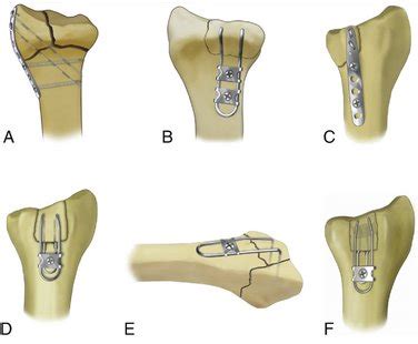 Fragment Specific Fixation Of Distal Radius Fractures Clinical Gate