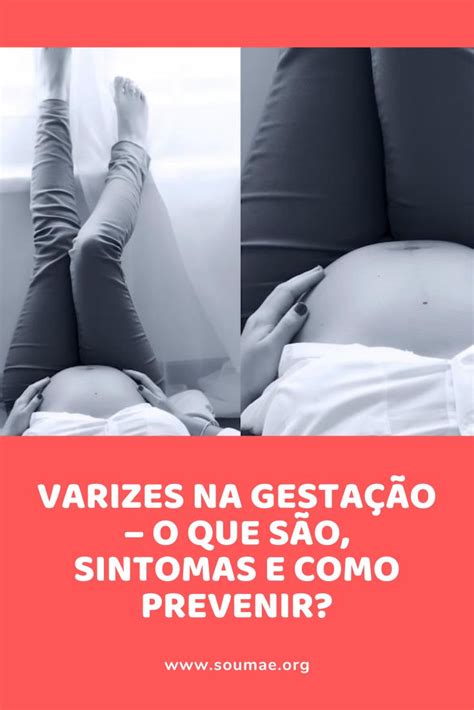 Varizes Na Gesta O O Que S O Sintomas E Como Prevenir Varizes