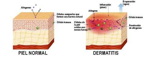 Dermatitis atópica causas prevención y tratamiento