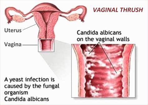 Vaginal Thrush Recurrent Nice Cks