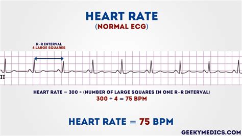 How To Read An ECG ECG Interpretation EKG Geeky Medics