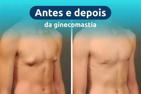 Antes E Depois Da Cirurgia De Ginecomastia Entenda Tudo