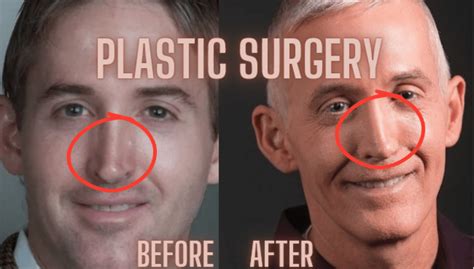 Unveiled The Mysterious Transformation Of Trey Gowdy S Nose