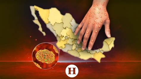 Viruela del mono en México MAPA de los ESTADOS donde han aumentado los