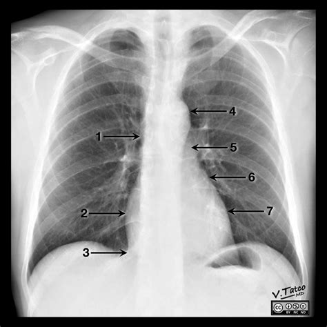 Lateral Chest X Ray Anatomy Anatomical Charts Posters