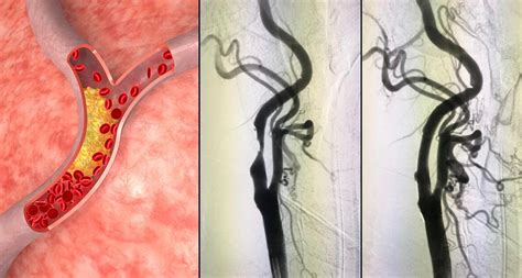 Angioplastia de carótida como é Neocure