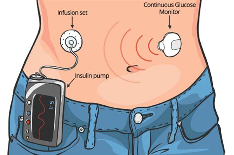 Automated Insulin Delivery Enhancing T D Glycemic Control