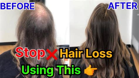How To Stop Hair Fall Naturally At Home Hair Fall Treatment Hair