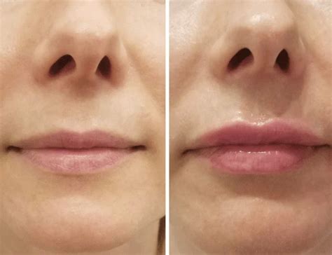 The Ultimate Guide To Lip Flip Before And After Results Flash Uganda