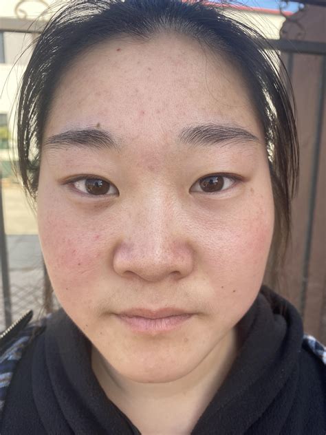 Nexdata Human Facial Skin Defects Data Datasets At Hugging Face