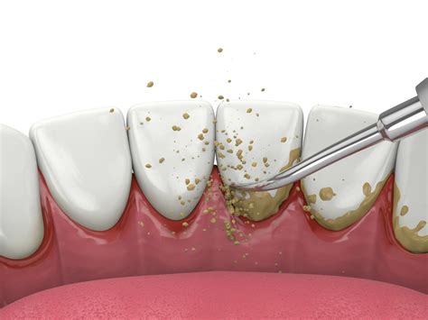 What Is Plaque And How Can It Harm My Teeth