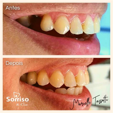 Implante Dentario Sorriso Cia