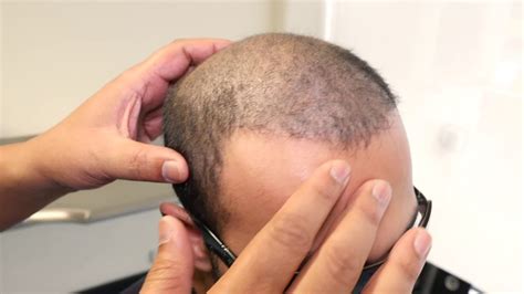 How To Repair A Botched Hair Transplant From A Black Market Clinic
