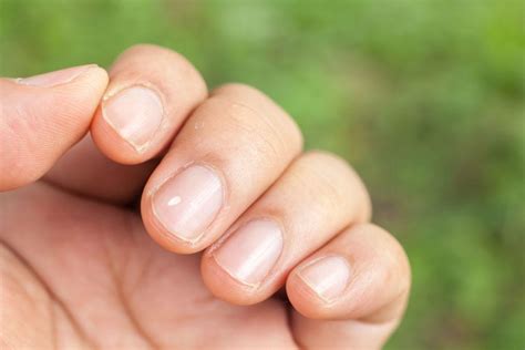 Por qué salen manchas blancas en las uñas