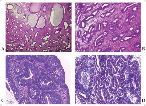 Histopathological Aspects Of Atypical And Non Atypical Endometrial