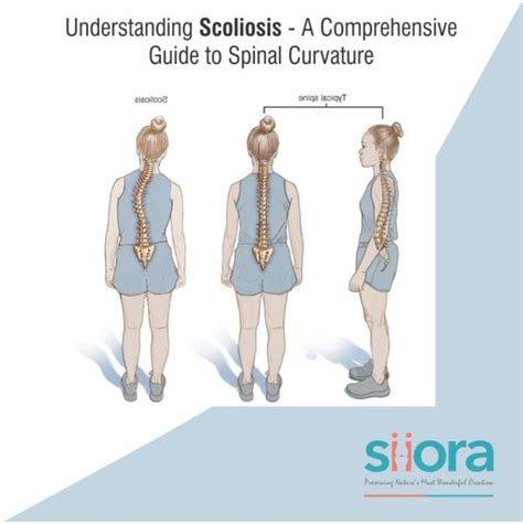 What Is Scoliosis A Comprehensive Guide Siora Surgicals Private Limited