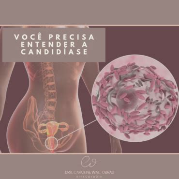 Candidíase Dra Caroline Obrali Ginecologista Curitiba