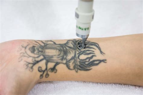 Eliminación de tatuajes en Mallorca Mallorca DERMATIVA