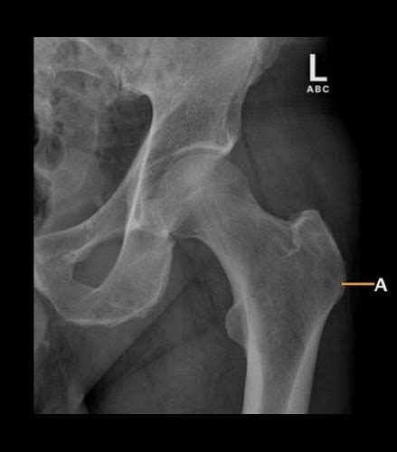 Radiography Positioning Hip Pelvis Flashcards Quizlet