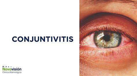 Conjuntivitis cuáles son sus síntomas y cómo podemos tratarla YouTube