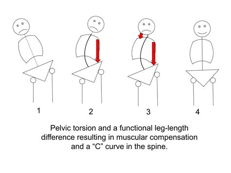 A Twisted Pelvis Also Called Pelvic Torsion Can Be Corrected