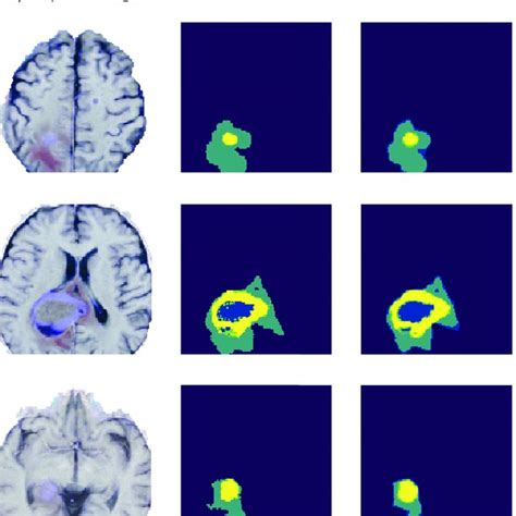 pdf moving medical image analysis to gpu embedded systems application to brain tumor segmentation