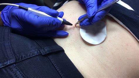 Skin Tag Removal Using Electrolysis Advanced Cosmetic Procedures Youtube