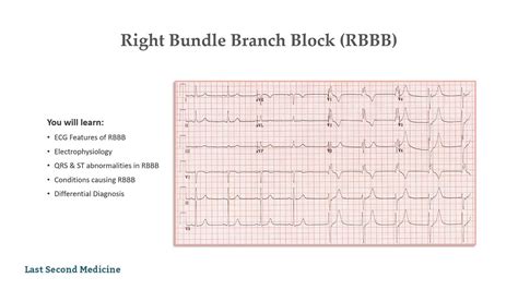 Right Bundle Branch Block RBBB Features Electrophysiology Causes