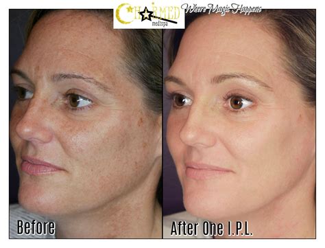 IPL The Ultimate Way To Improve Sun Spots Rosecea And Redness