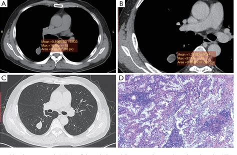 Figure 1 From Differential Diagnosis Of Pulmonary Nodular Mucinous