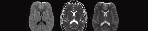 brain tumor detection mri kaggle