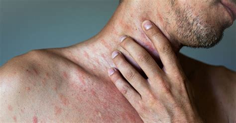 Causas sintomas e tratamentos da Dermatite Atópica
