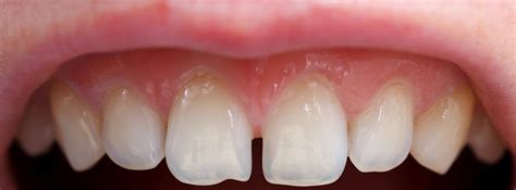 Why Are My Teeth Transparent Atlanta Orthodontic Specialists