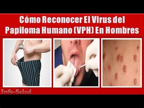 Virus Del Papiloma Humano Como Reconocer El Virus En Los Hombres Youtube