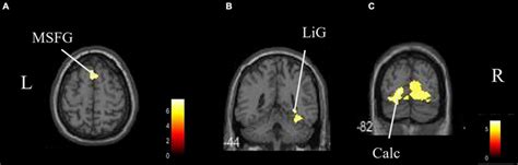Brain Areas That Were Significantly More Activated By ASMR Stimulation