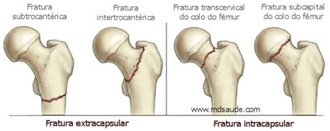 Fratura Do Colo Do F Mur Causas Sintomas E Tratamento