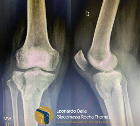 Tratamento De Fraturas Do Planalto Tibial Dr Leonardo Rocha Thomaz